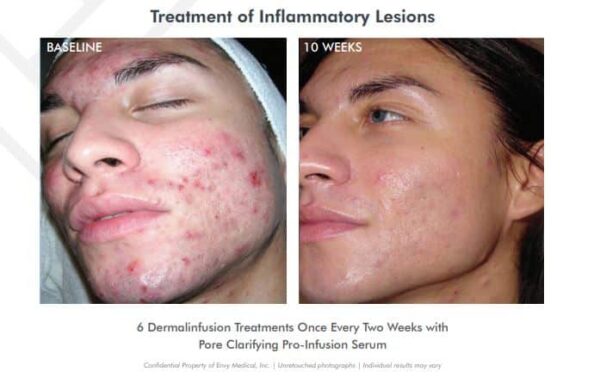 Dermal Infusion | Olivo Medspa - Chicago IL